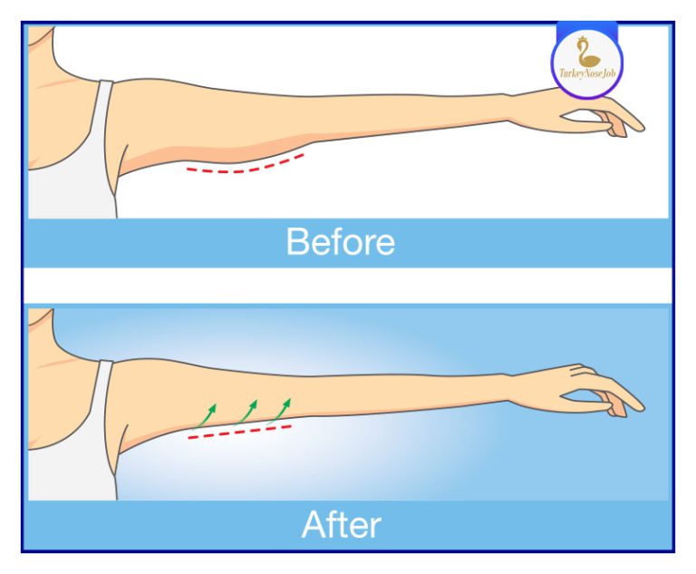 Important and key points about arm lift - learn more - Turkeynosejob ...